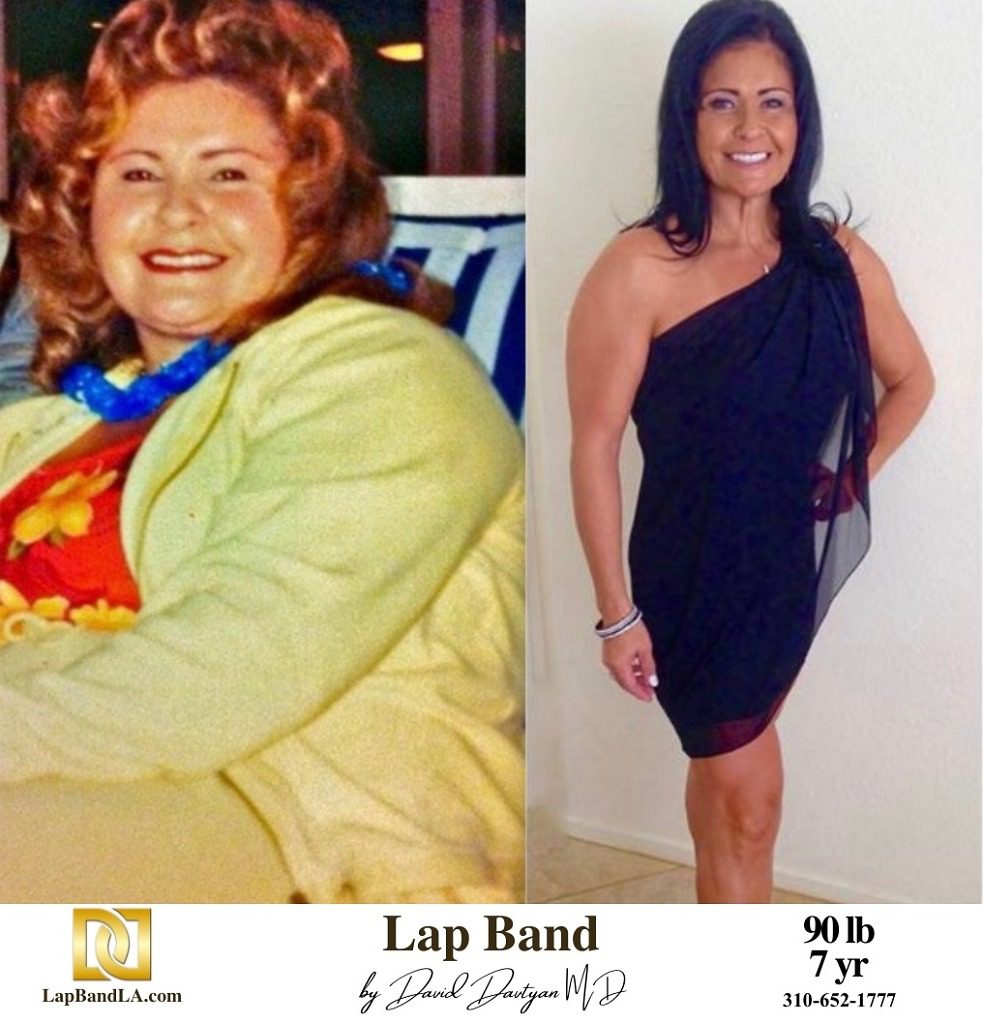 Lap-Band Surgery Los Angeles | Lap-Band Los Angeles